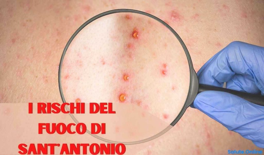 Fuoco di Sant'Antonio collegato all'infarto? Lo studio svela l'aumento ...